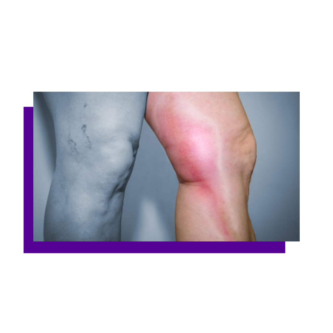 Dor, formigamento e fadiga nas pernas? Pode ser varizes, te explico ...