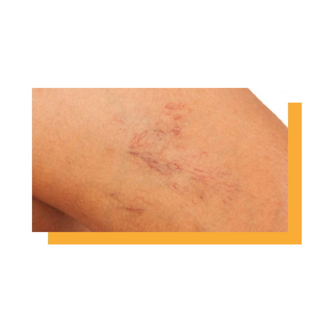 Dor, formigamento e fadiga nas pernas? Pode ser varizes, te explico ...